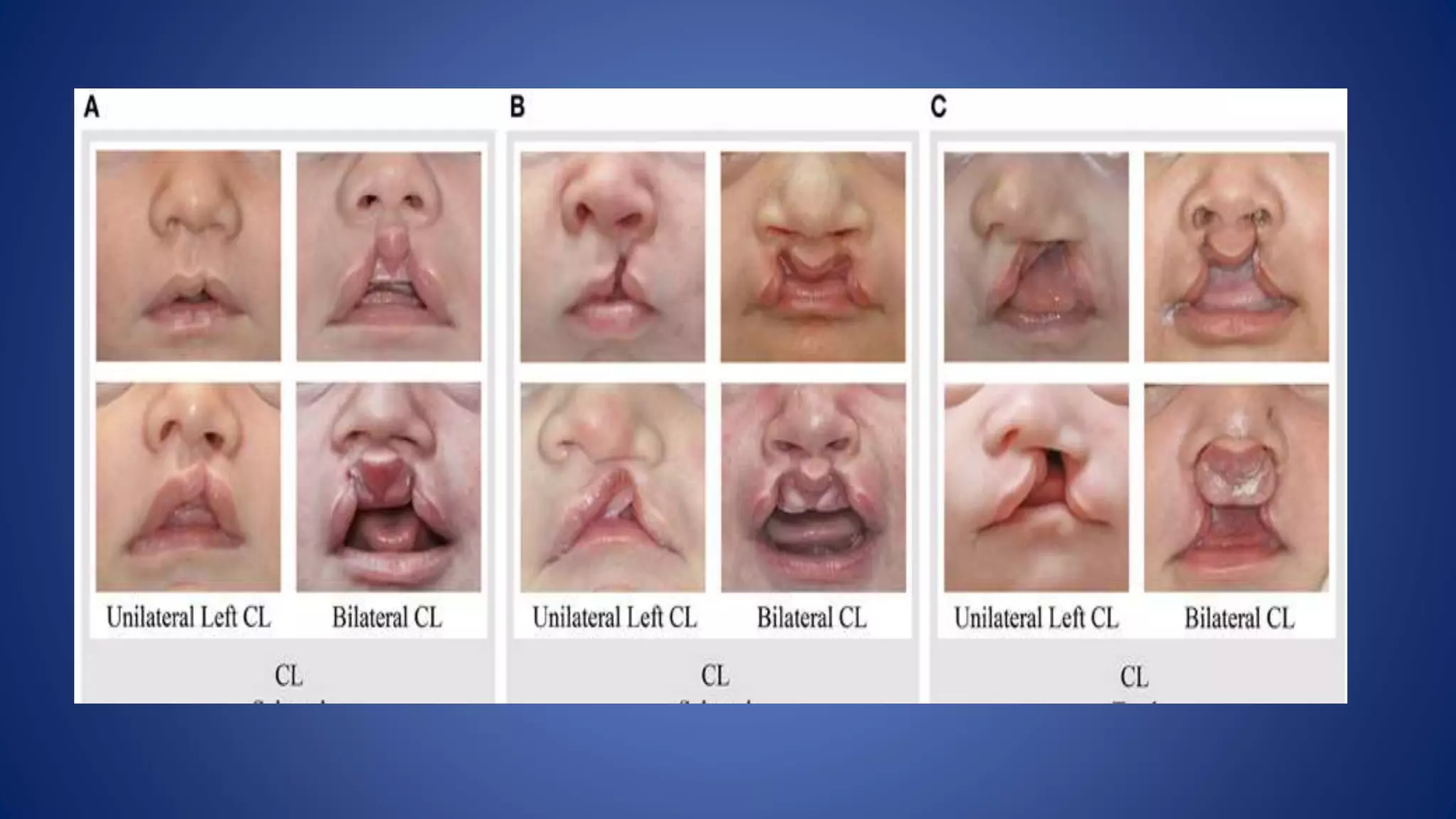 DEVELOPMENT OF PALATE AND ITS ANOMALIES | PPTX