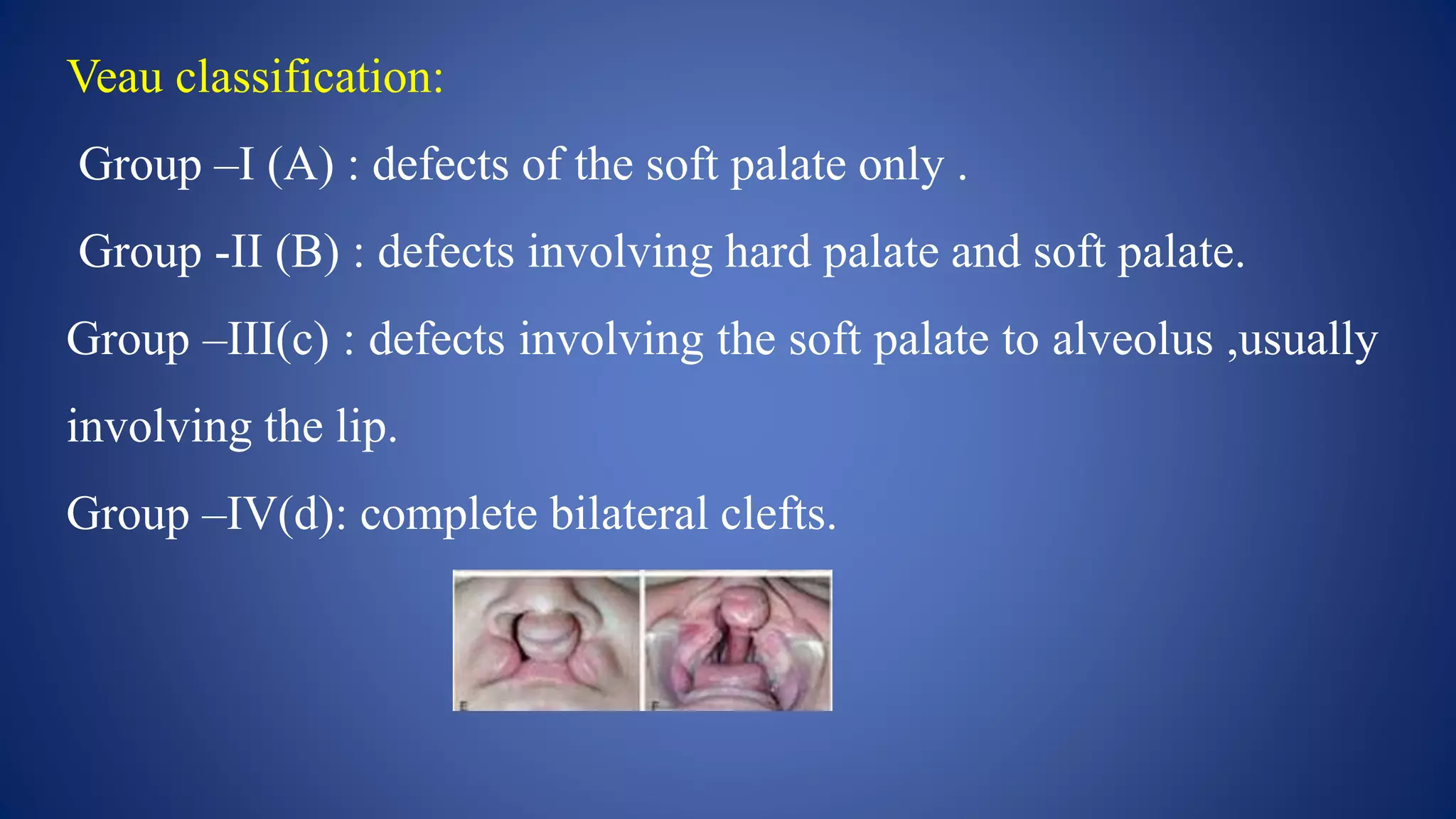 DEVELOPMENT OF PALATE AND ITS ANOMALIES | PPTX