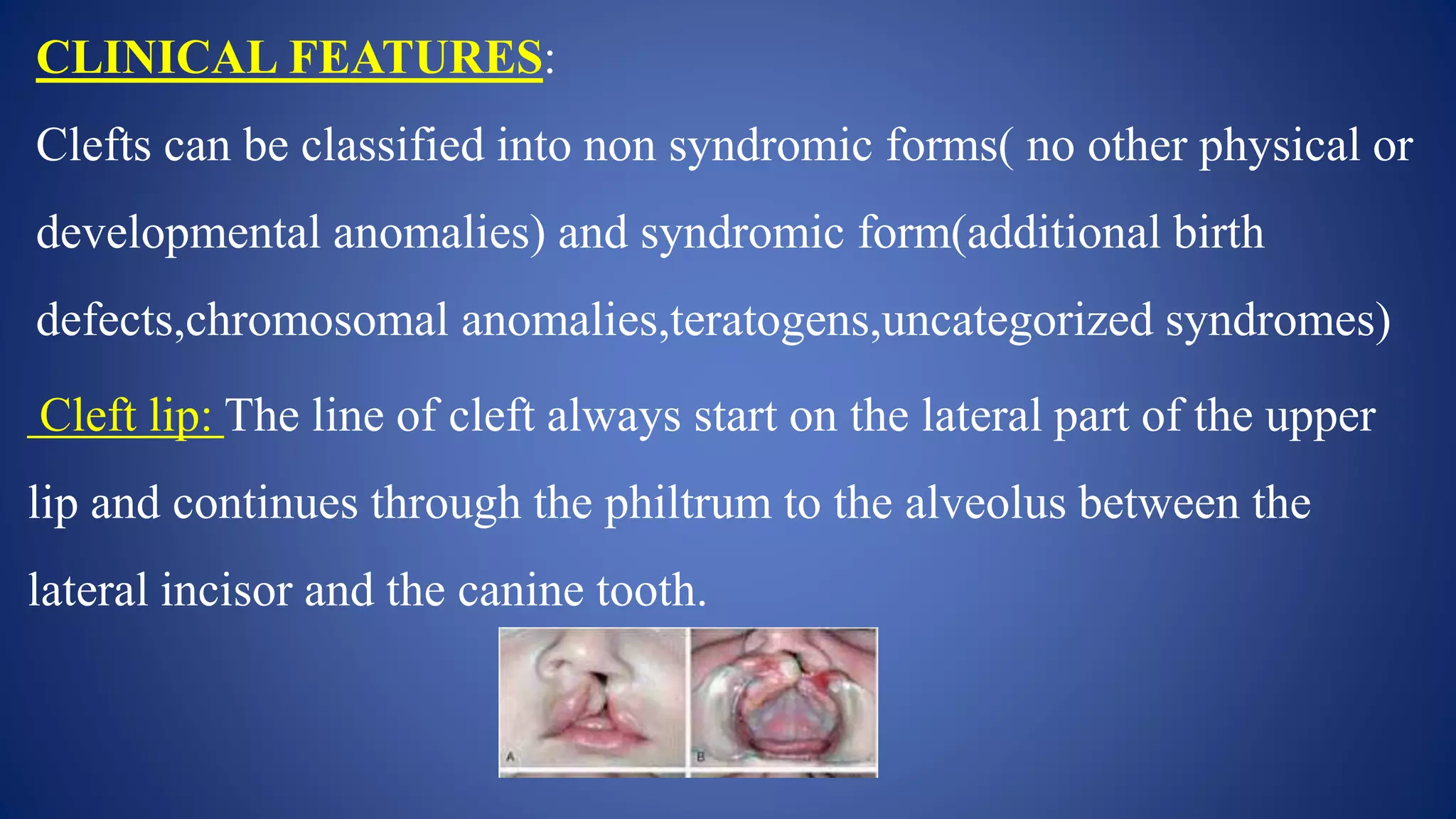 DEVELOPMENT OF PALATE AND ITS ANOMALIES | PPTX