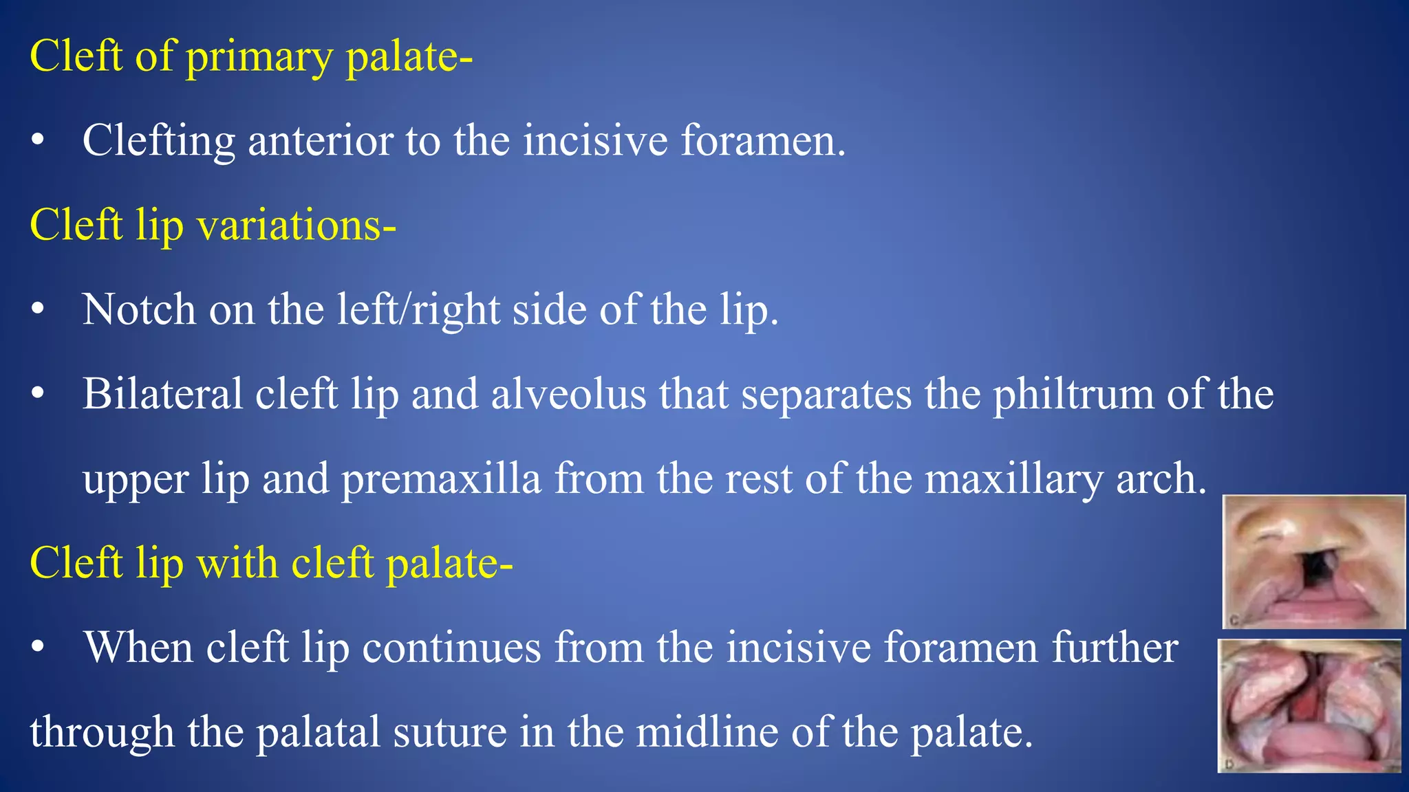 DEVELOPMENT OF PALATE AND ITS ANOMALIES | PPTX