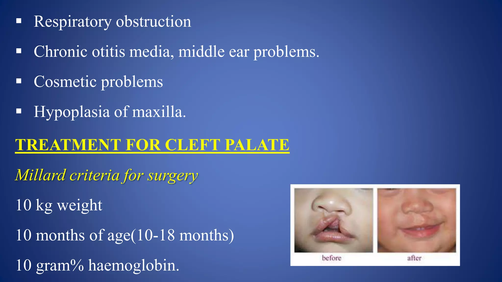 DEVELOPMENT OF PALATE AND ITS ANOMALIES | PPTX