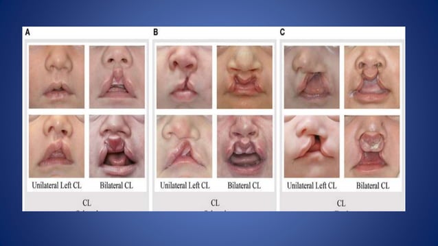 DEVELOPMENT OF PALATE AND ITS ANOMALIES | PPTX