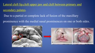 DEVELOPMENT OF PALATE AND ITS ANOMALIES | PPTX