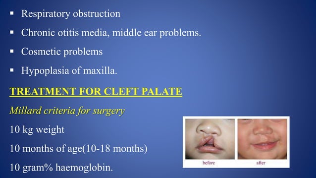 DEVELOPMENT OF PALATE AND ITS ANOMALIES | PPTX