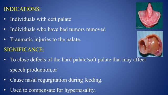 DEVELOPMENT OF PALATE AND ITS ANOMALIES | PPTX