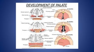 DEVELOPMENT OF PALATE AND ITS ANOMALIES | PPT