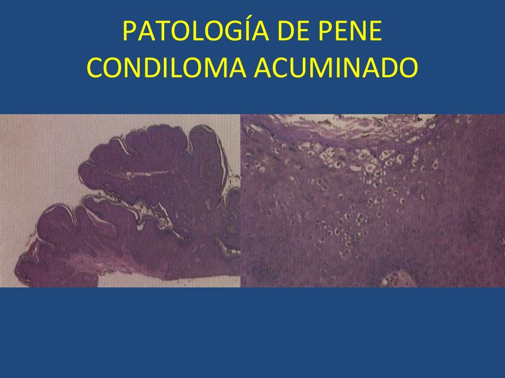 Patología Cutánea Del Pene : Dermatitis en el pene: Causas, síntomas y ...