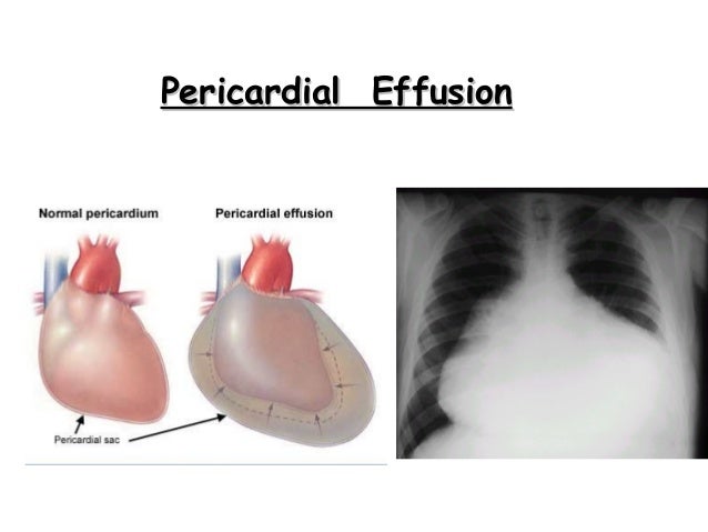 1 pericardium