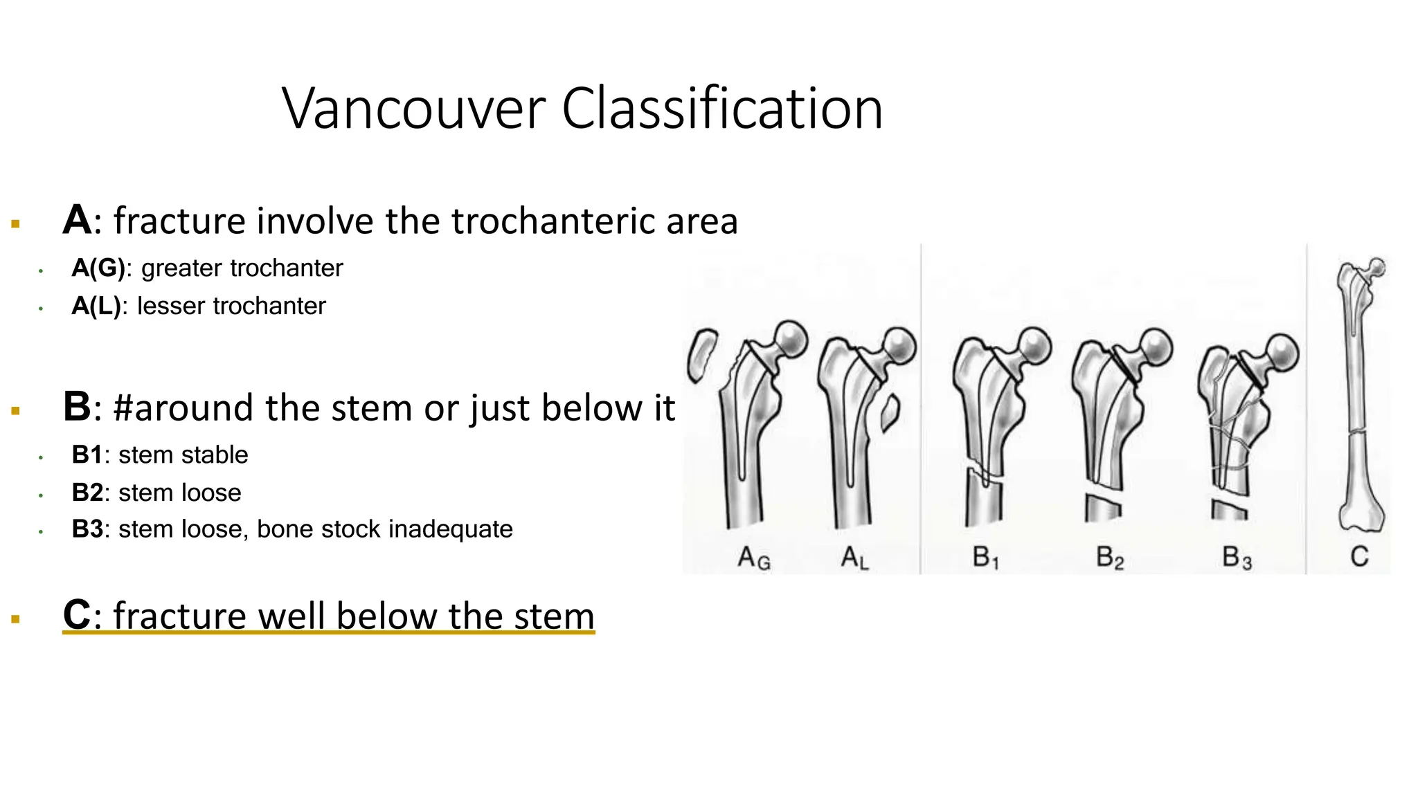 1periprosthetic fracture around hip.pptx