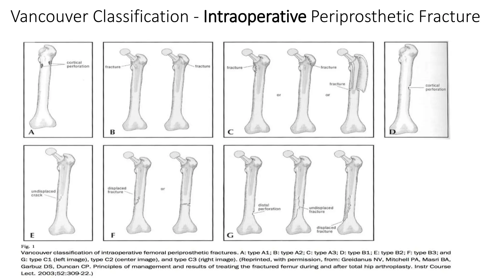1periprosthetic fracture around hip.pptx