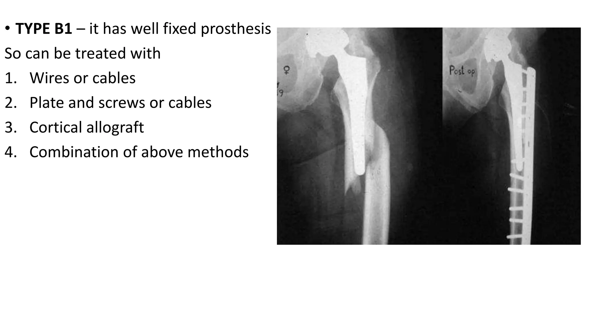 1periprosthetic fracture around hip.pptx