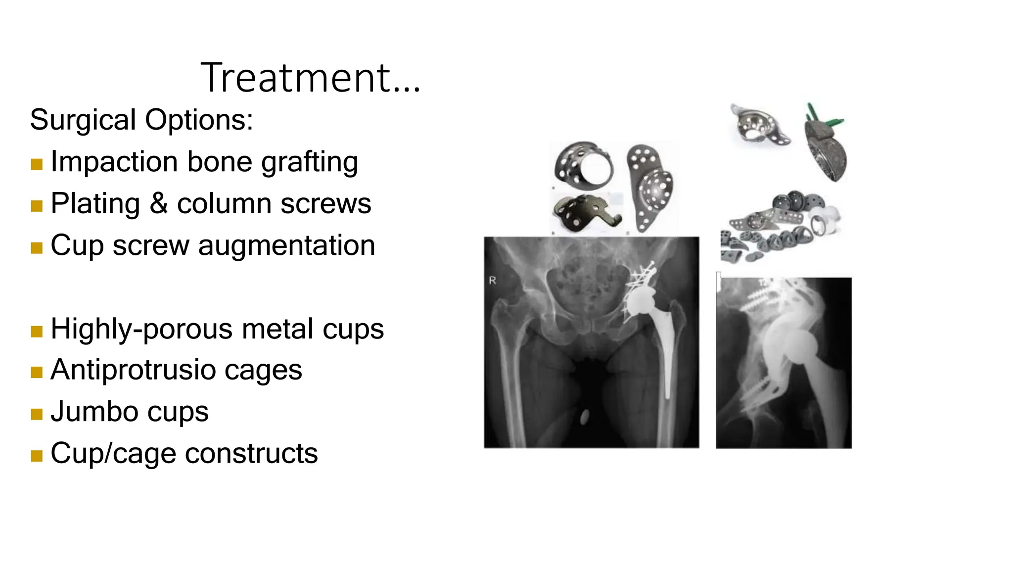 1periprosthetic fracture around hip.pptx