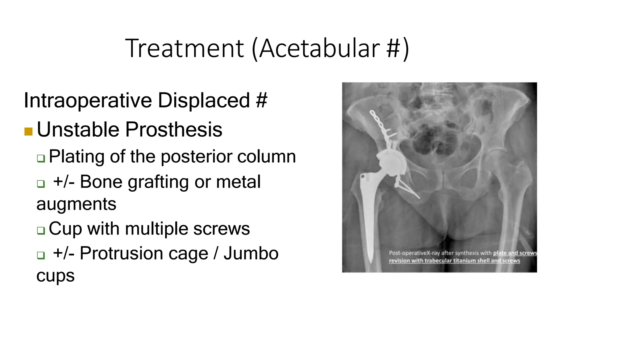 1periprosthetic fracture around hip.pptx