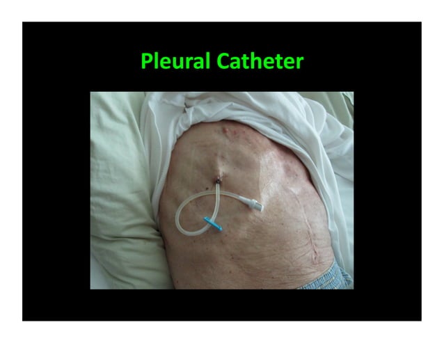 1 pleurx jclub3.16.11