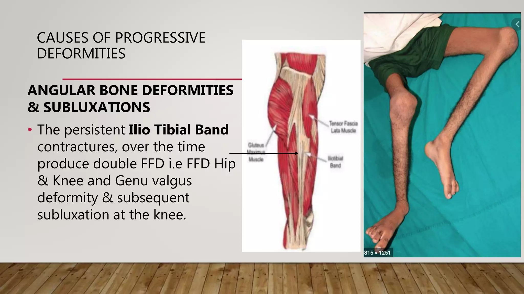 Post Polio Residual Palsy: Pathophysiology & Principles of Rx | PPTX