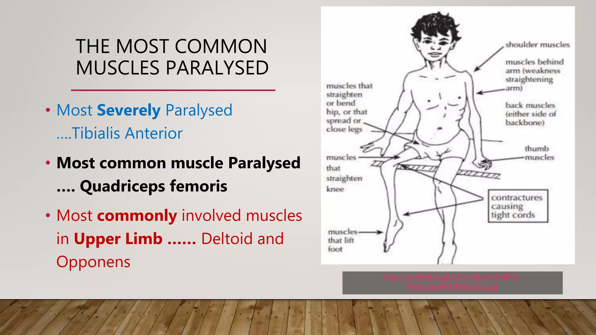 Post Polio Residual Palsy: Pathophysiology & Principles of Rx | PPTX