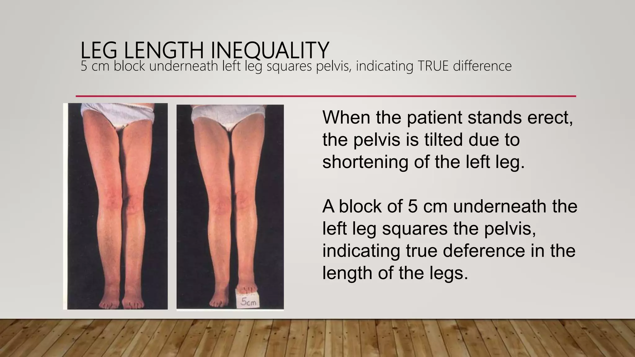 Post Polio Residual Palsy: Pathophysiology & Principles of Rx | PPTX
