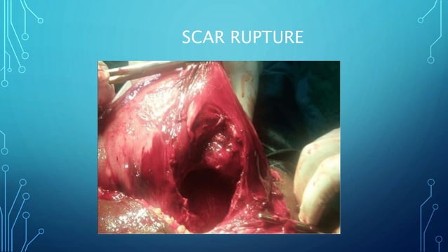 Pregnancy with previous cesarean section | PPTX | Pregnancy | Reproductive Health