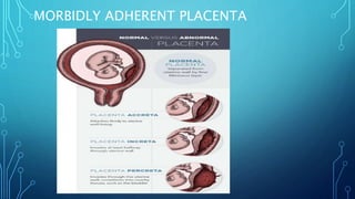 Pregnancy with previous cesarean section | PPTX