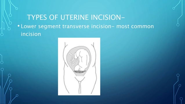 Pregnancy with previous cesarean section | PPTX | Pregnancy | Reproductive Health