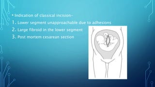 Pregnancy with previous cesarean section | PPTX