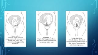 Pregnancy with previous cesarean section | PPTX
