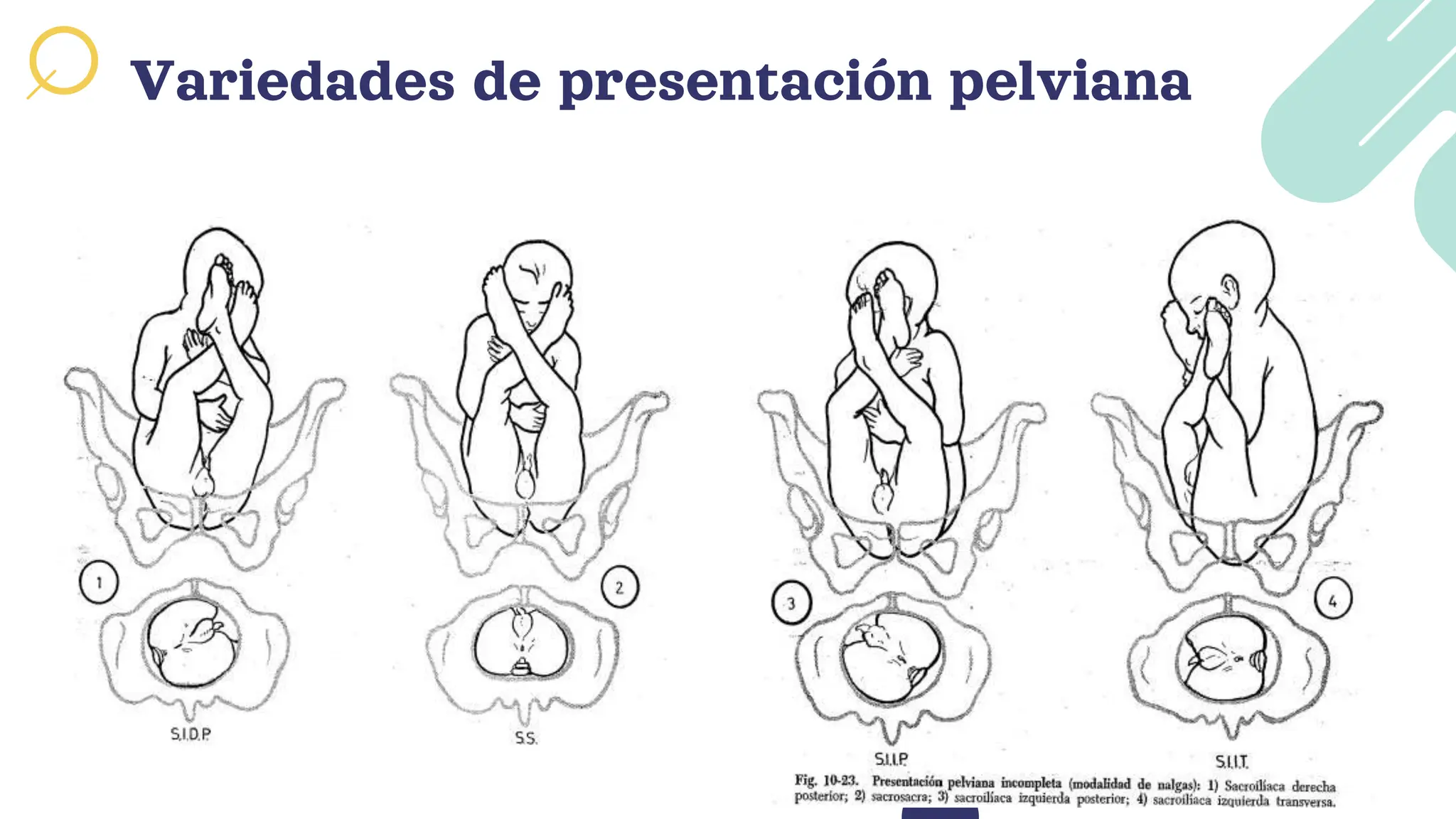 Presentación podálica y transversa y mecanismo de parto | PPTX ...