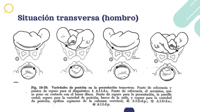 Presentación podálica y transversa y mecanismo de parto | PPTX ...