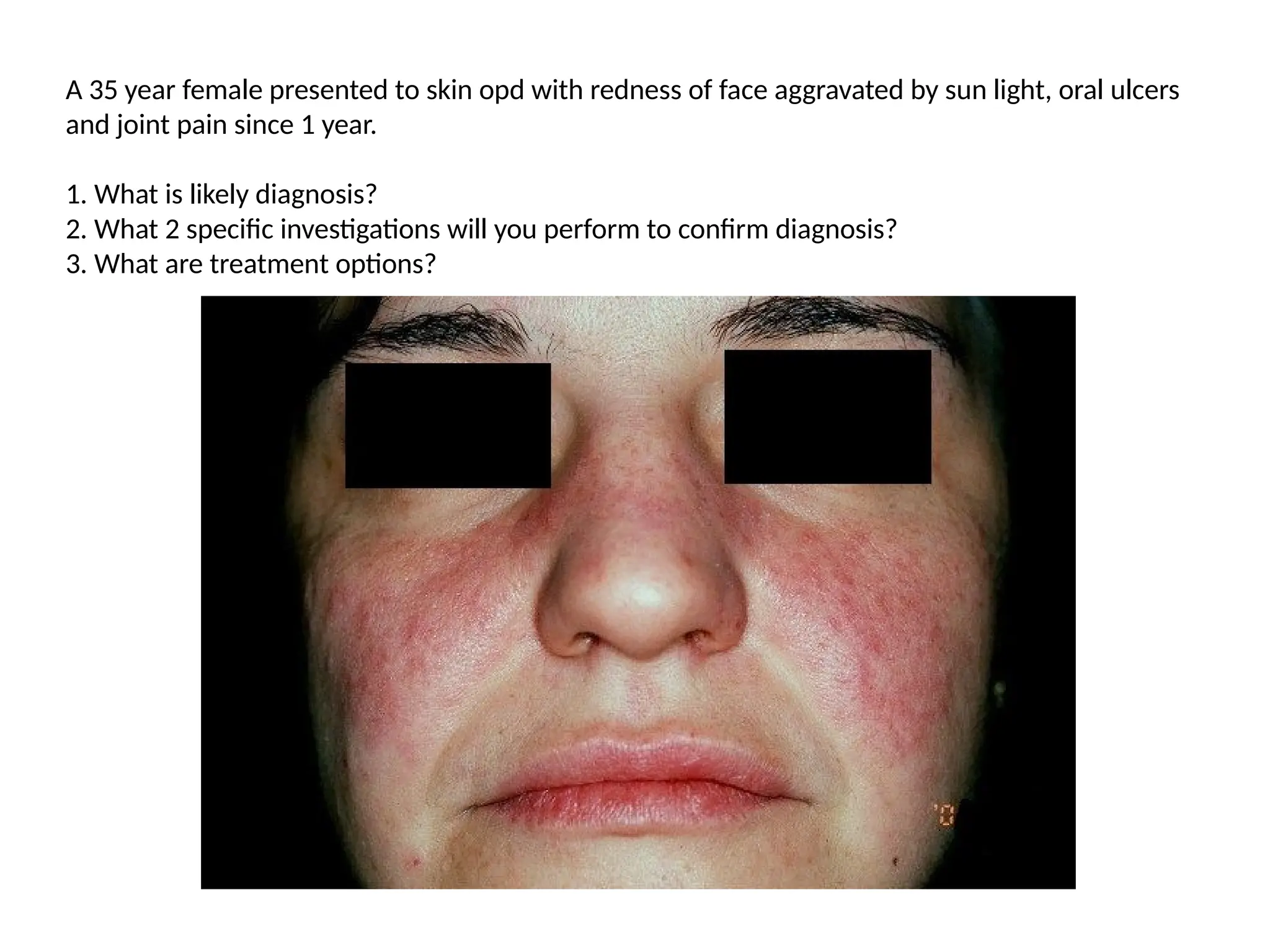 Mcq on systemic lupus erythematosus having facial rash | PPT
