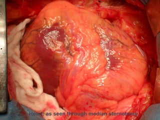 Open heart surgery, cvs | PPT