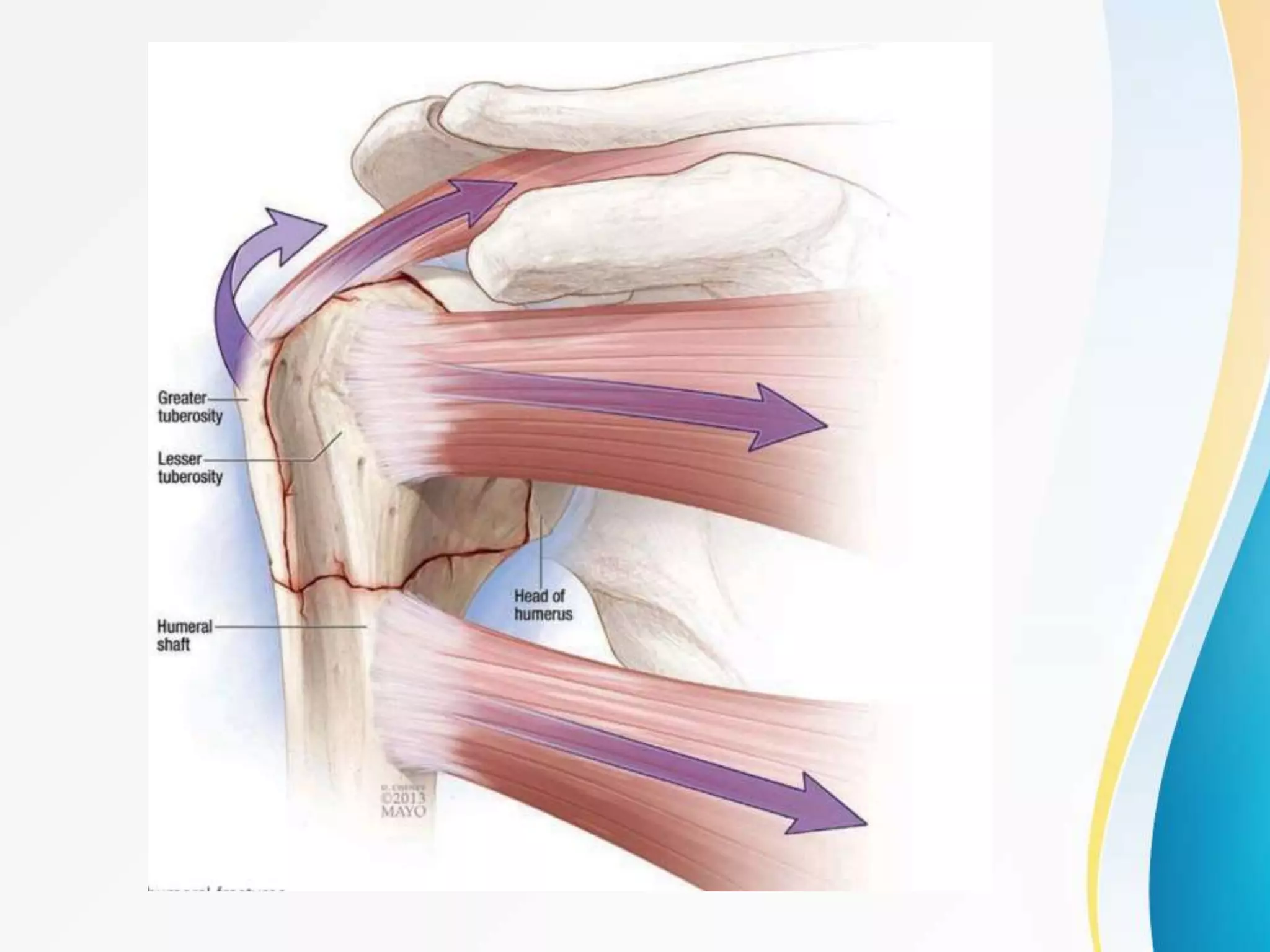 1PROXIMAL_HUMERUS_FRACTURES_SURGICAL_MANAGEMENT_PHILOS_PLATING_FINAL.pptx