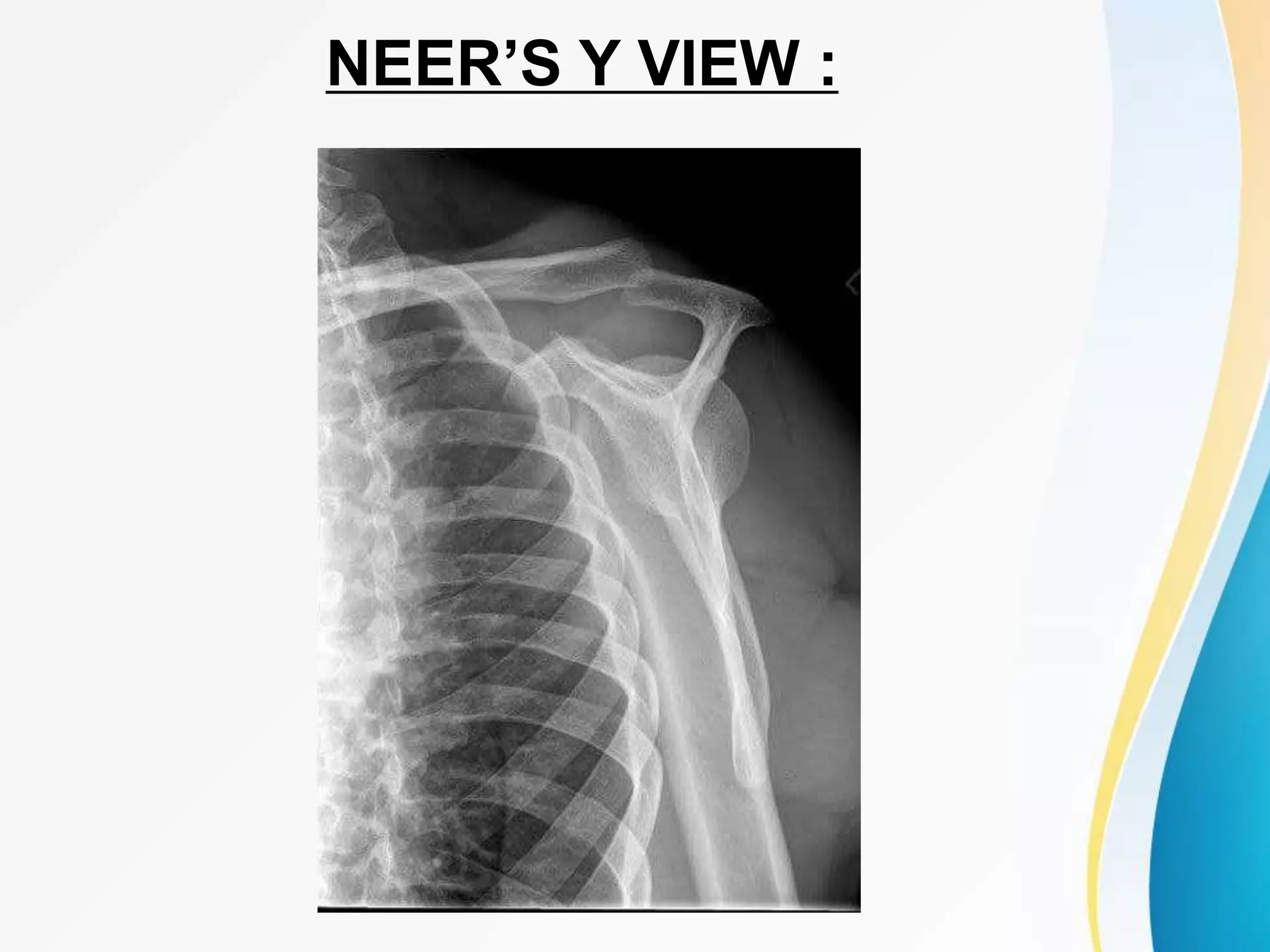 1PROXIMAL_HUMERUS_FRACTURES_SURGICAL_MANAGEMENT_PHILOS_PLATING_FINAL.pptx