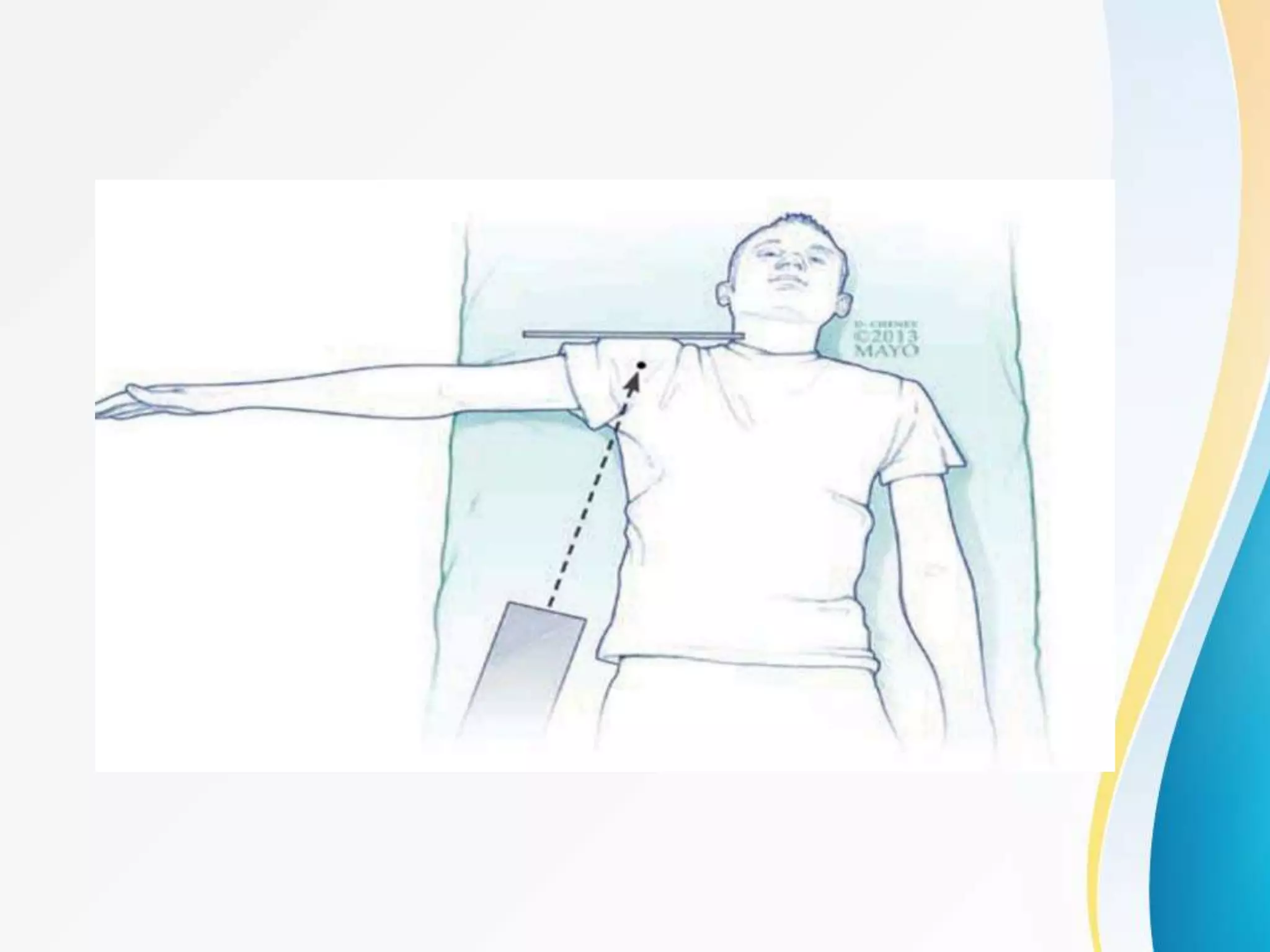 1PROXIMAL_HUMERUS_FRACTURES_SURGICAL_MANAGEMENT_PHILOS_PLATING_FINAL.pptx