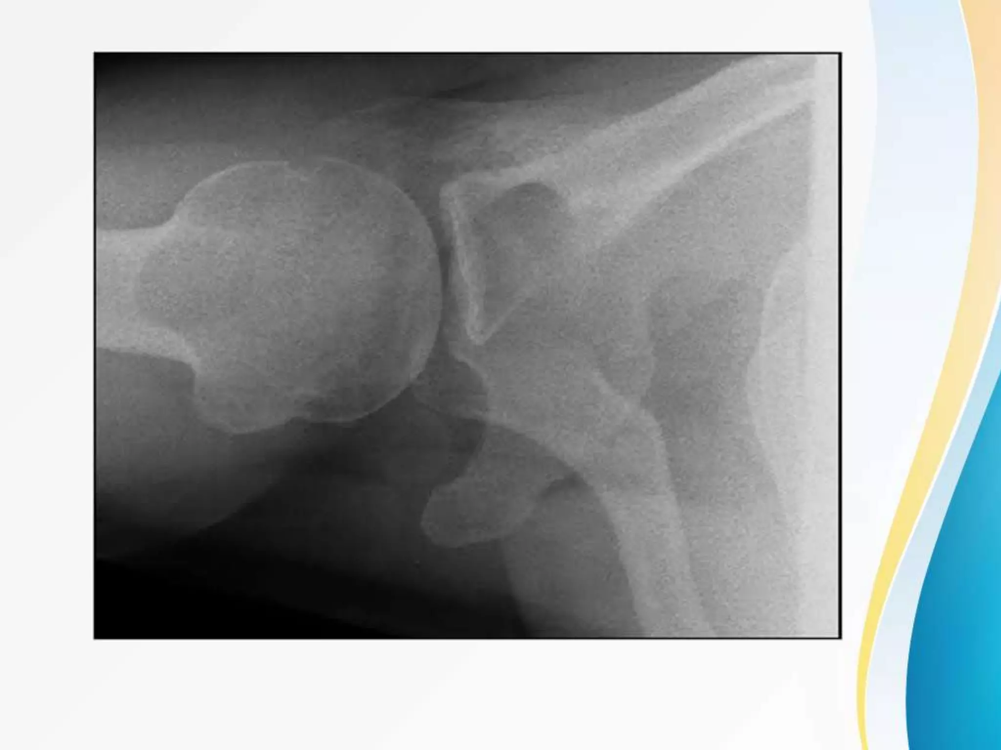 1PROXIMAL_HUMERUS_FRACTURES_SURGICAL_MANAGEMENT_PHILOS_PLATING_FINAL.pptx
