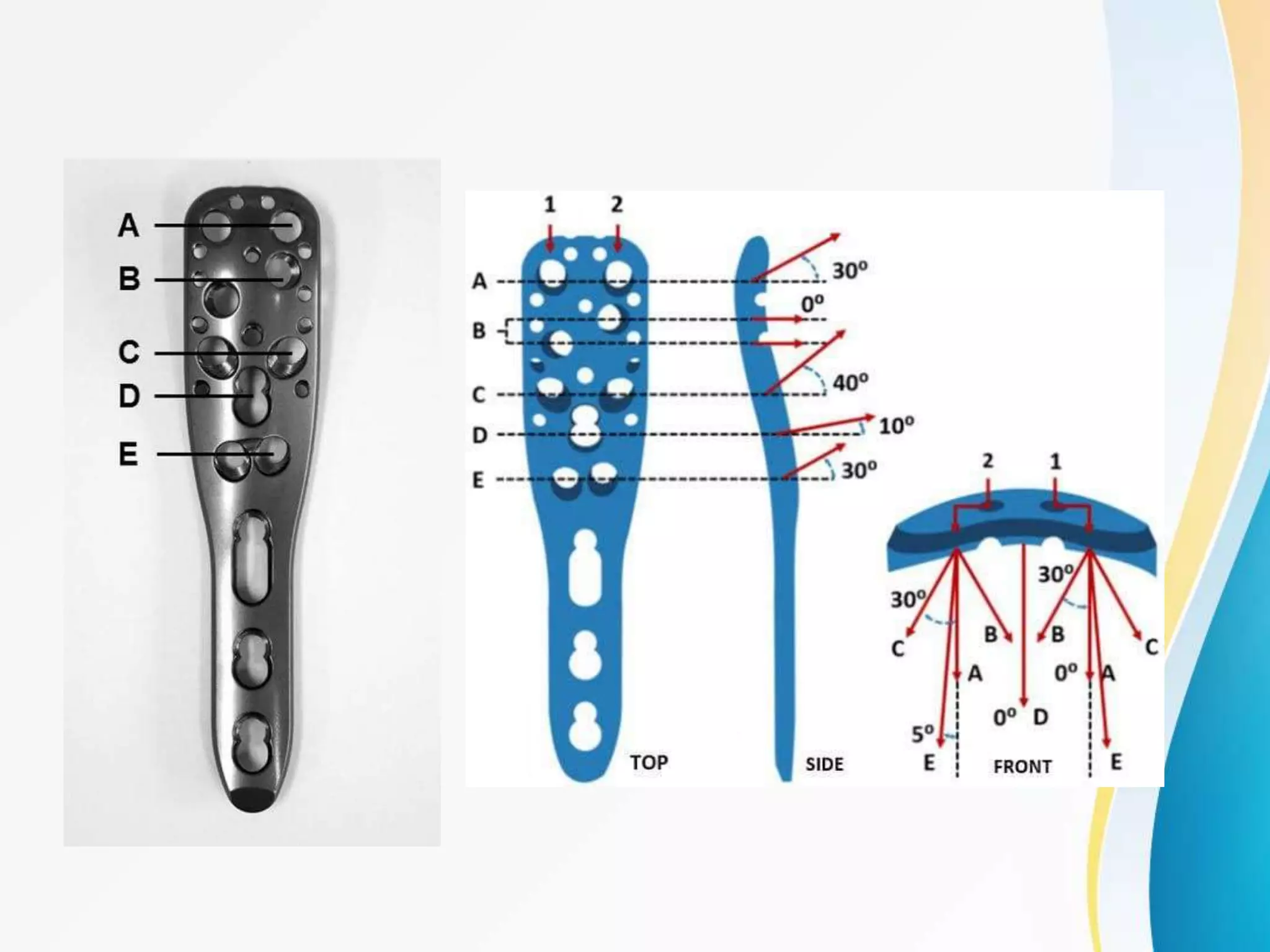 1PROXIMAL_HUMERUS_FRACTURES_SURGICAL_MANAGEMENT_PHILOS_PLATING_FINAL.pptx