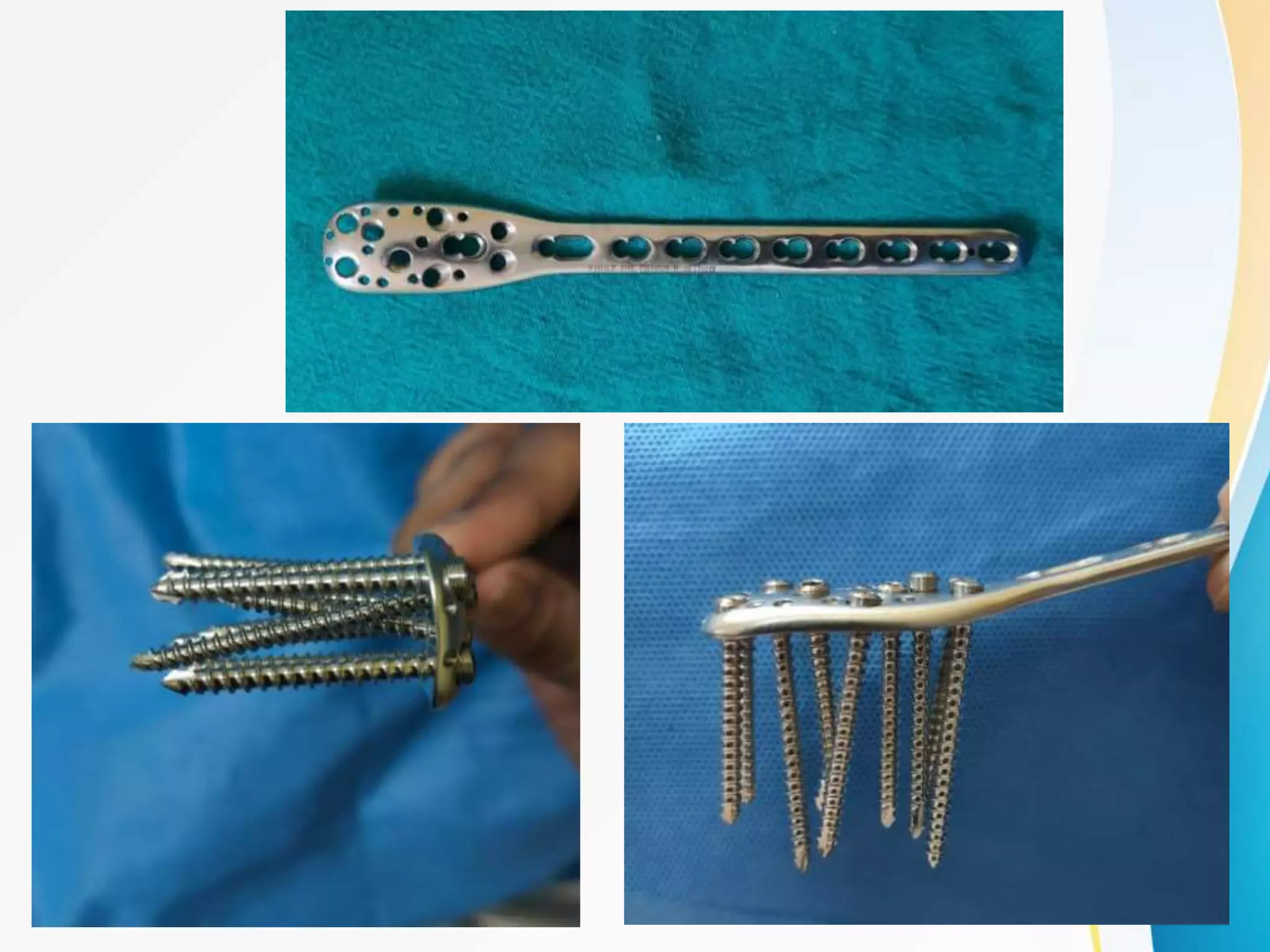 1PROXIMAL_HUMERUS_FRACTURES_SURGICAL_MANAGEMENT_PHILOS_PLATING_FINAL.pptx