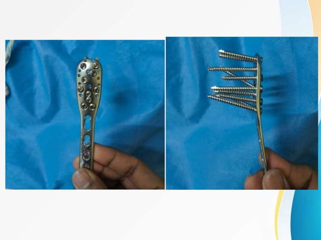 1PROXIMAL_HUMERUS_FRACTURES_SURGICAL_MANAGEMENT_PHILOS_PLATING_FINAL ...