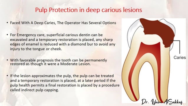 pulp irritant and protection by Dr Islam Alsakkaf | PPTX