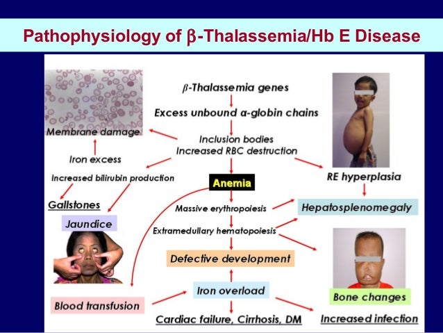 thalassemia