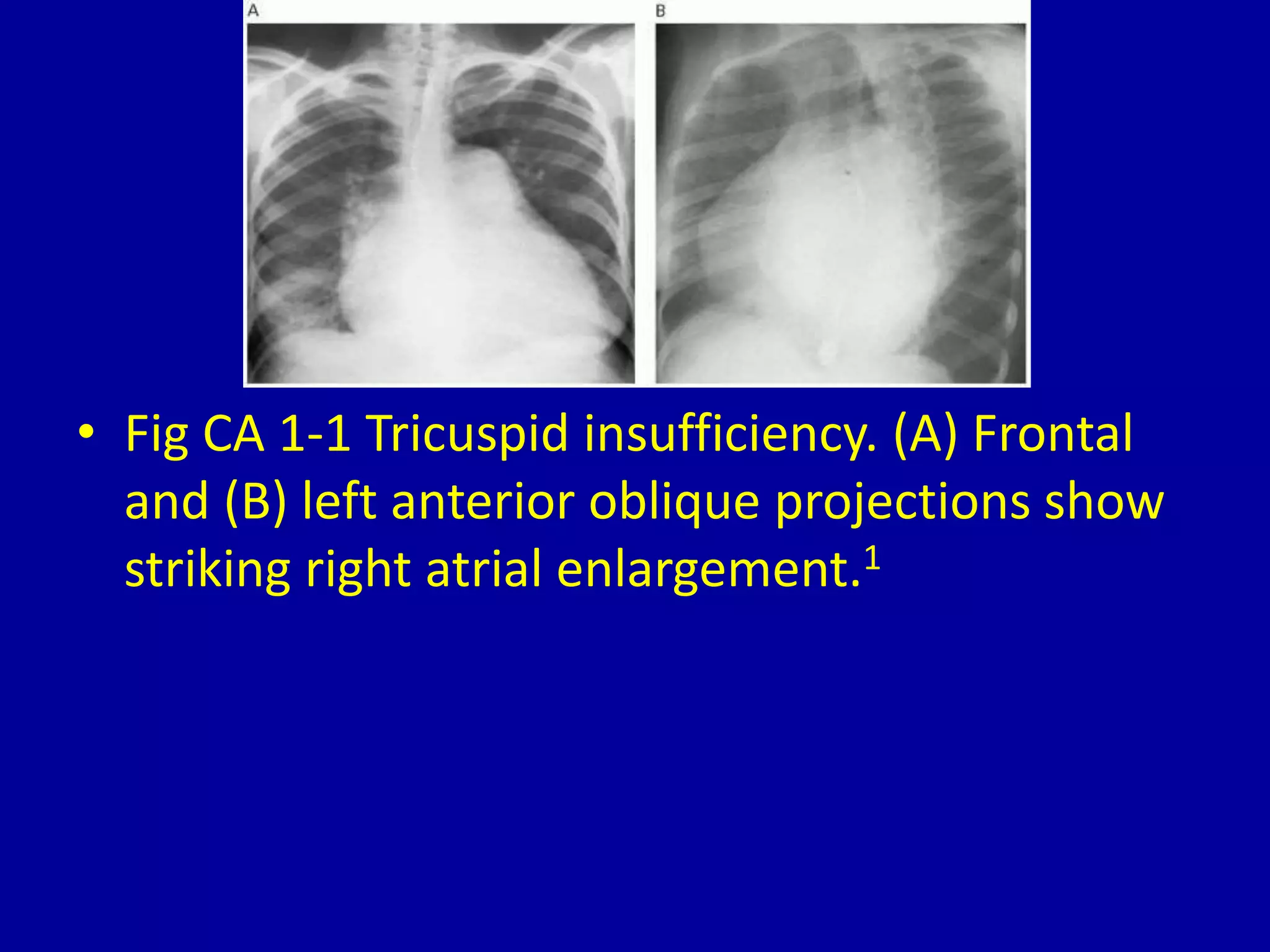 1 right atrial enlargement | PPTX