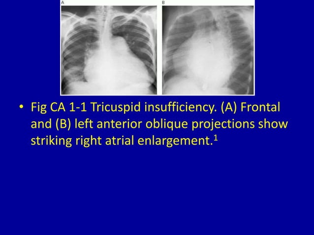 1 right atrial enlargement | PPTX