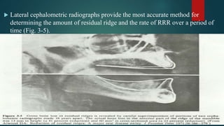 Residual ridge reduction in removable prosthodontics | PPTX