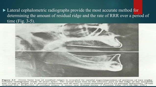 Residual ridge reduction in removable prosthodontics | PPTX