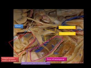 1 Anatomía microquirúrgica del seno cavernoso y fosa media | PPTX