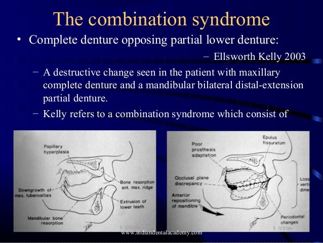 1 single complete denture/endodontic courses