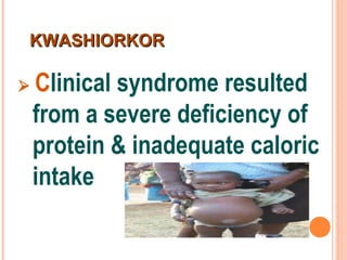 1slide share malnutrition modify | PPT