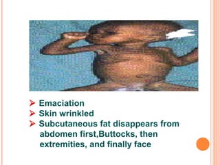 1slide share malnutrition modify | PPT