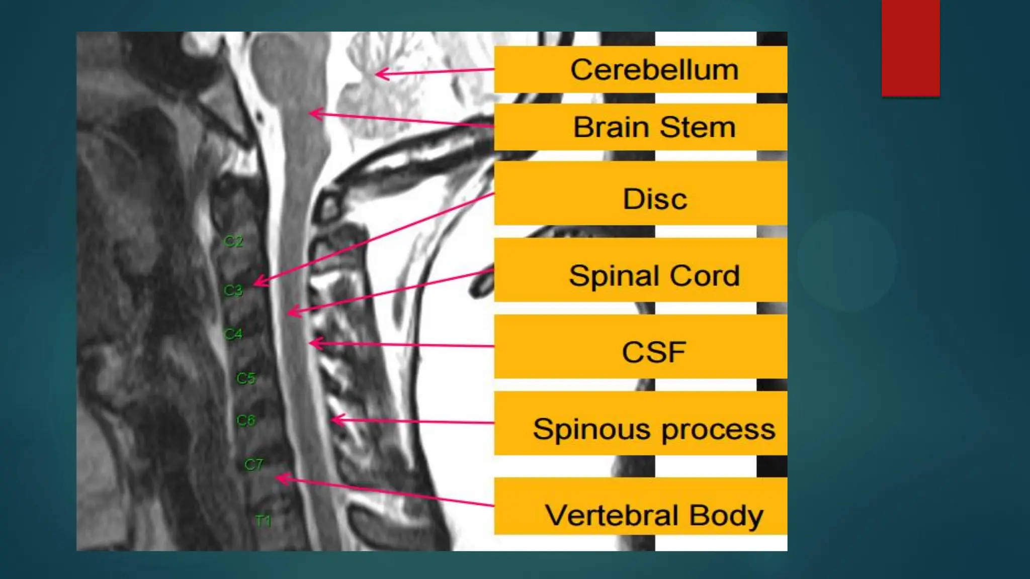 1) Spinal Cord radiology gross anatomy central nervous system | PDF ...