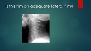 1) Spinal Cord radiology gross anatomy central nervous system | PDF