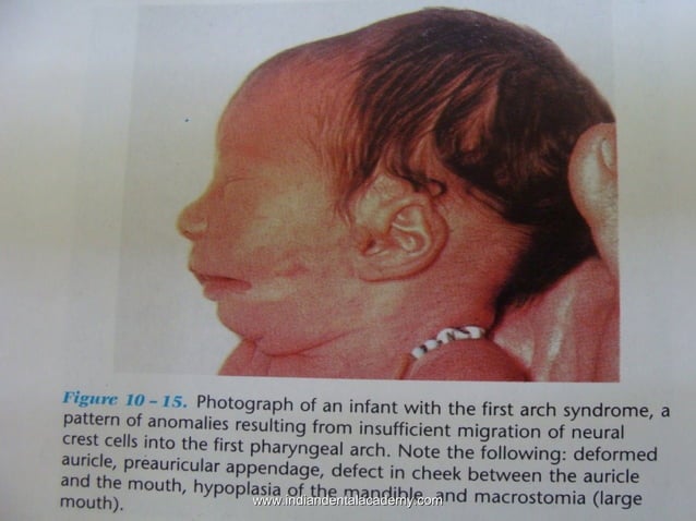 1st arch syndromes /prosthodontic courses | PPT